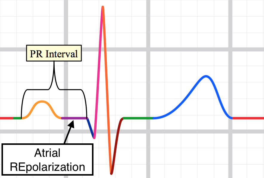 You Probably Have Not Thought About Atrial Repolarization Too Much you-probably-have-not-thought-about-atrial-repolarization-too-much